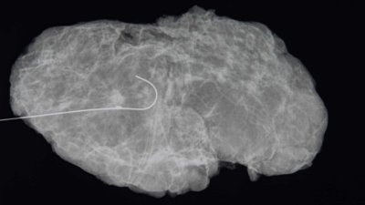 Los pacientes de cáncer de mama pueden descartar la mastectomía y optar ...